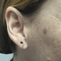 Torn Earlobe Repair | Brooklyn, NY | RR Plastix NY Plastic Surgery Center