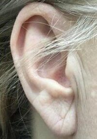 Torn Earlobe Repair | Brooklyn, NY | RR Plastix NY Plastic Surgery Center