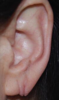 Torn Earlobe Repair | Brooklyn, NY | RR Plastix NY Plastic Surgery Center