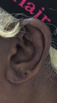 Torn Earlobe Repair | Brooklyn, NY | RR Plastix NY Plastic Surgery Center